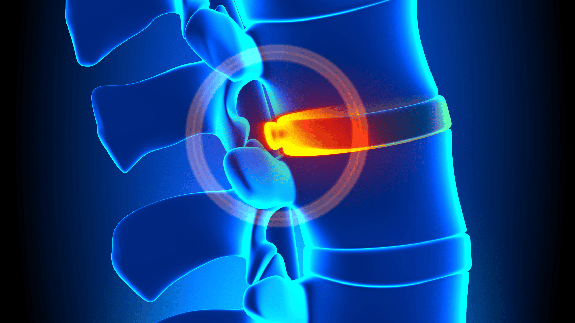 PRP Therapy for Disc Pain | Center for Pain Management