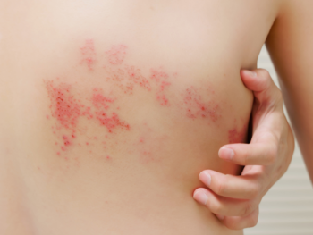 What Does Shingles Look Like? | Center for Pain Management
